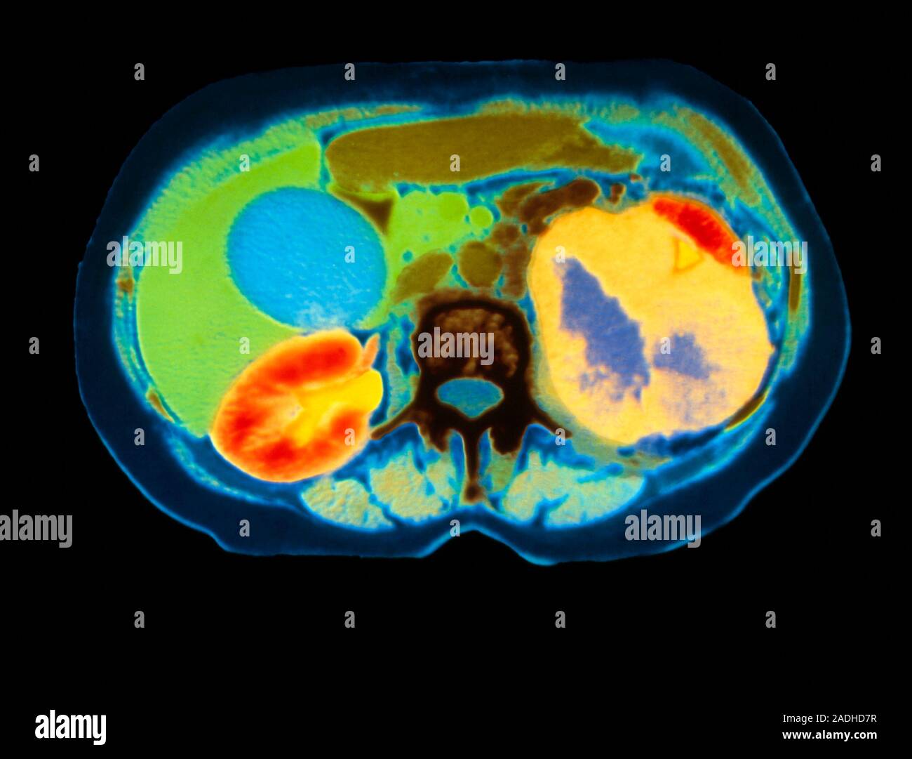 Kidney cancer. Coloured computed Tomography (CT) scan, axial section ... Kidney cancer. Coloured computed Tomography (CT) scan, axial section ...