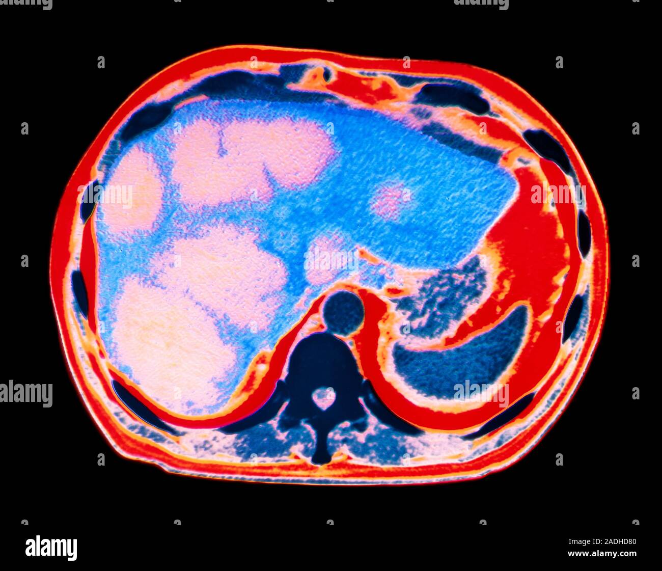 Liver cancer. Coloured computed tomography (CT) scan of an axial section through the human ...
