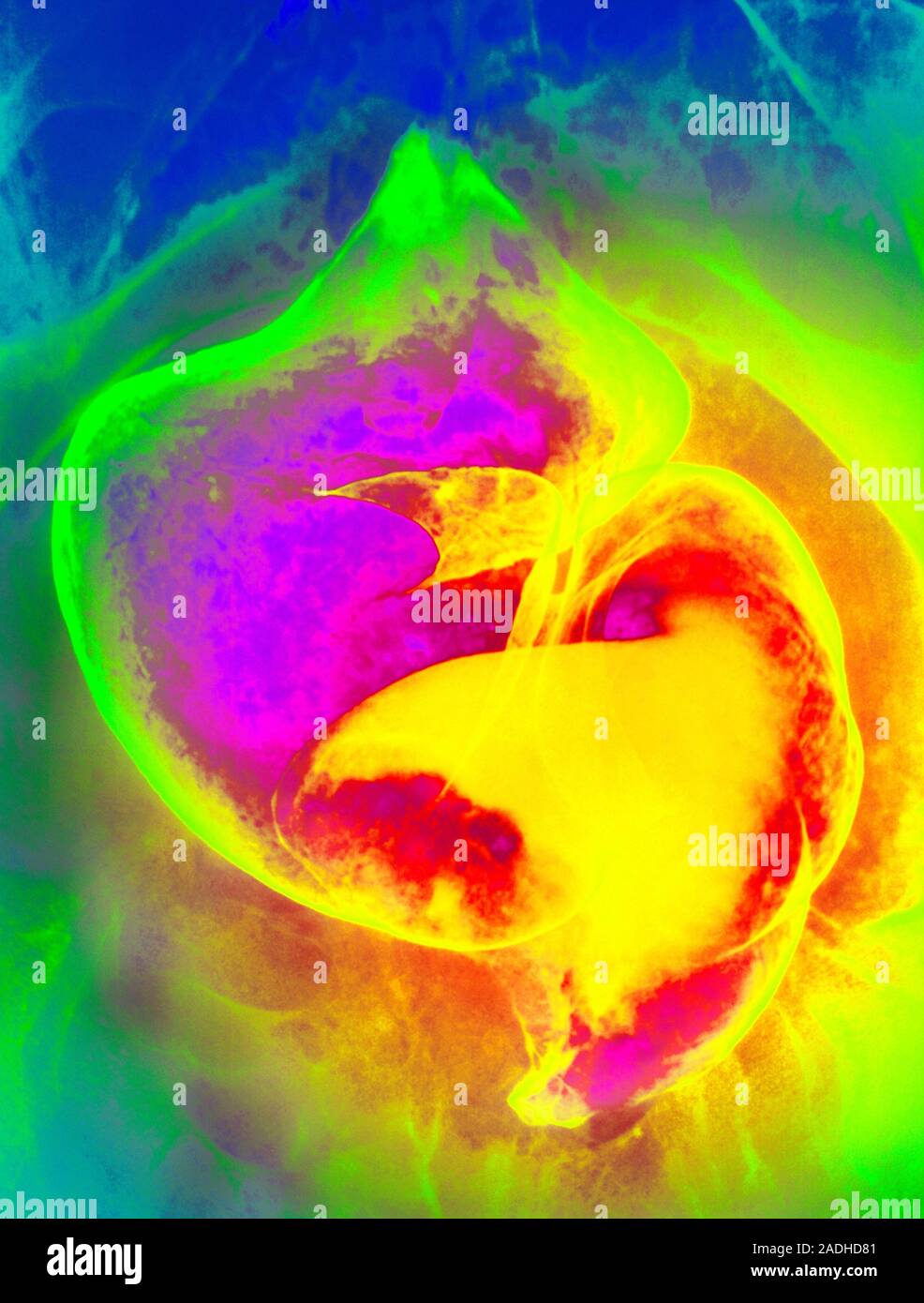 Colon cancer & polyp. X-ray of an apple core" tumour at the junction of ...