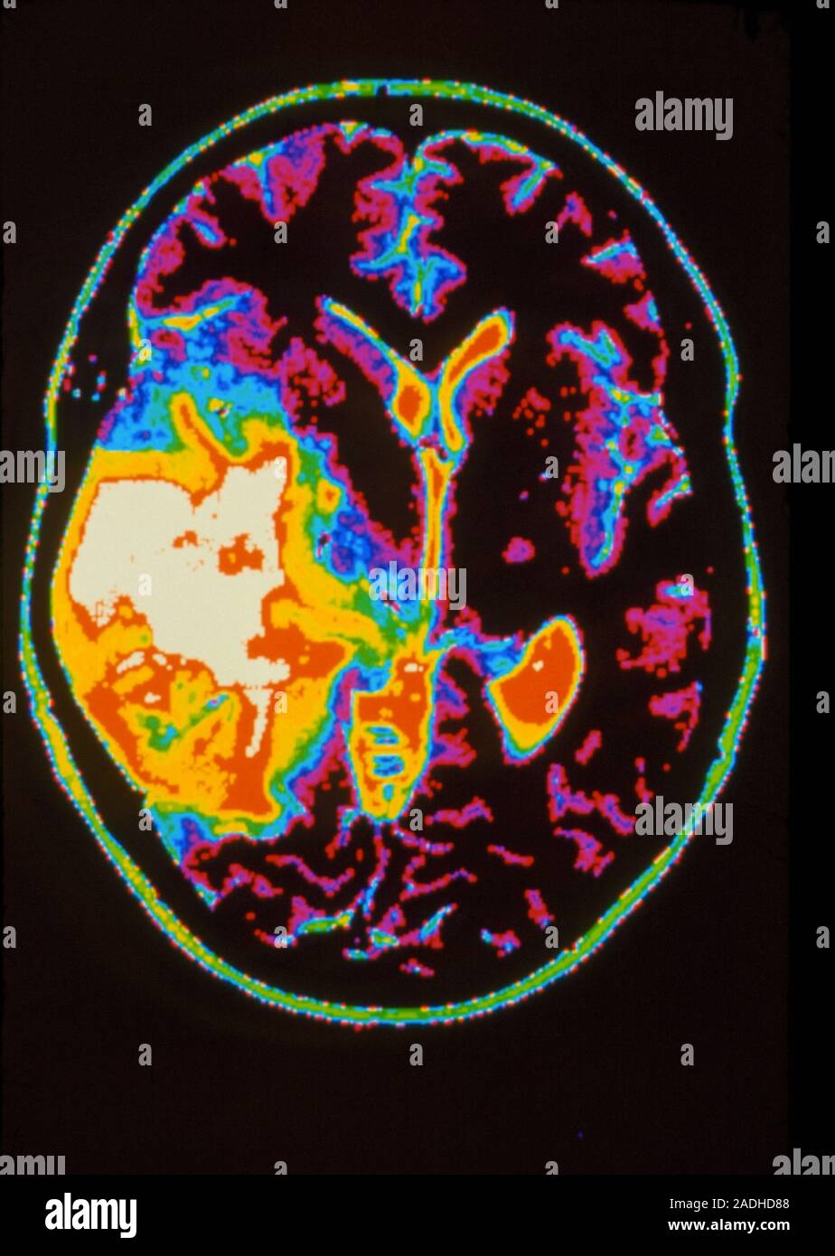 Brain oligodendroglioma. Coloured magnetic resonance imaging (MRI) scan of a rare type of ...