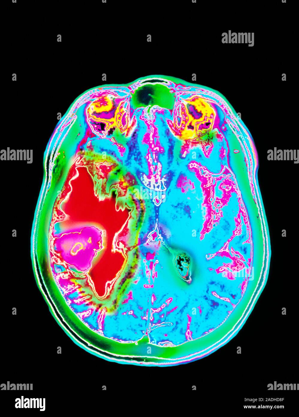 Brain tumour. Coloured Magnetic Resonance Imaging (MRI) scan of an axial section through the ...