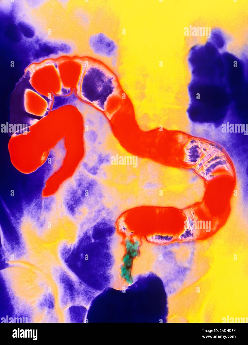 Rectal cancer. Coloured X-ray of the human abdomen in front view ...