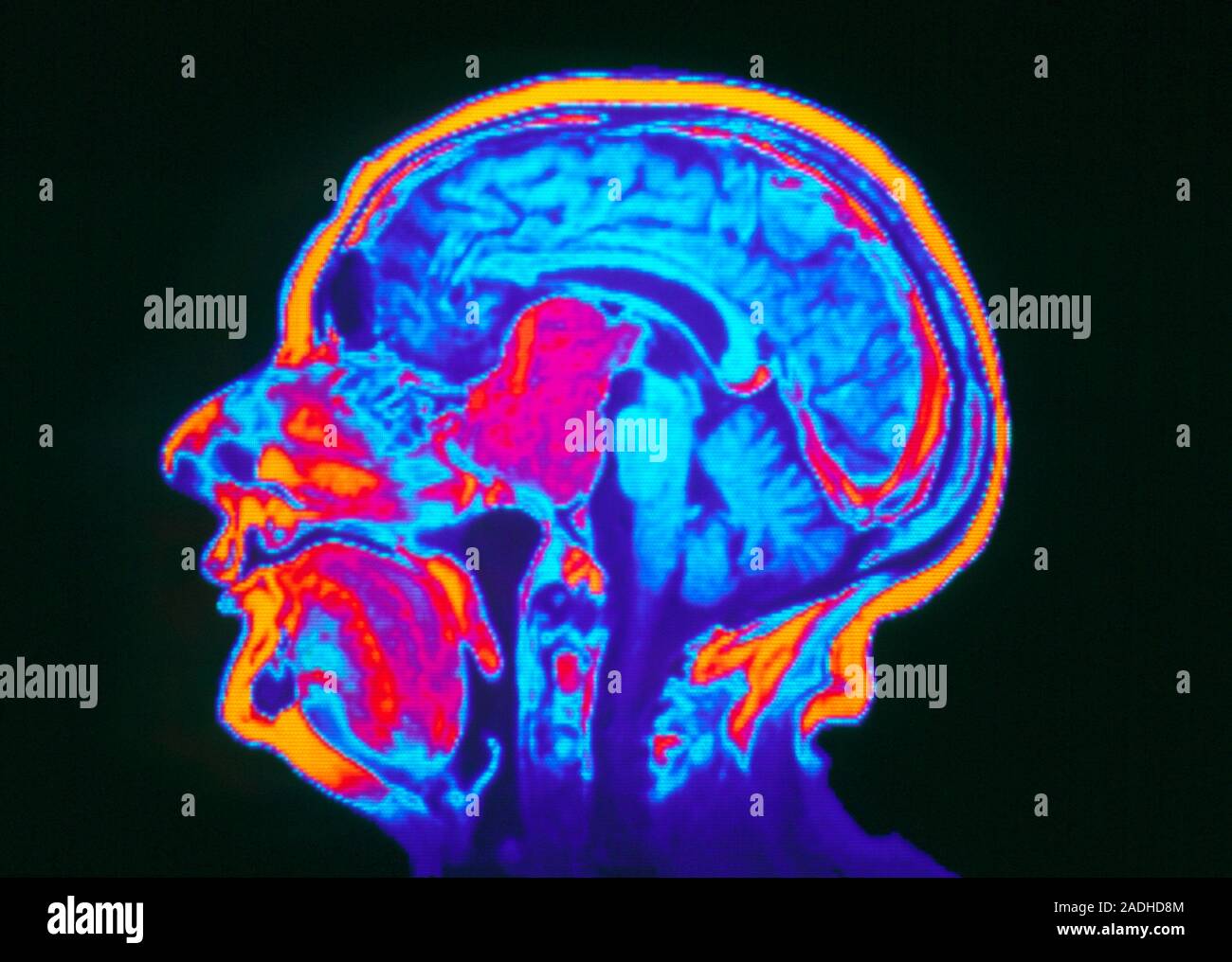 Pituitary Tumour Coloured Magnetic Resonance Imaging Mri Scan Of A