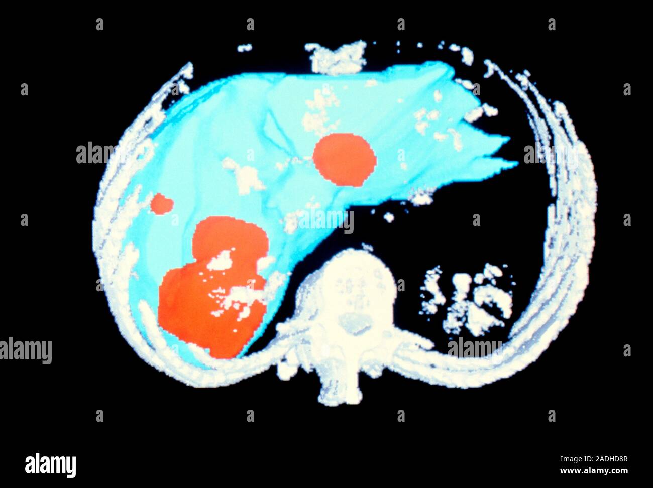 Metastatic liver cancer. Coloured 3-D computed tomography scan of a patient's abdomen showing ...