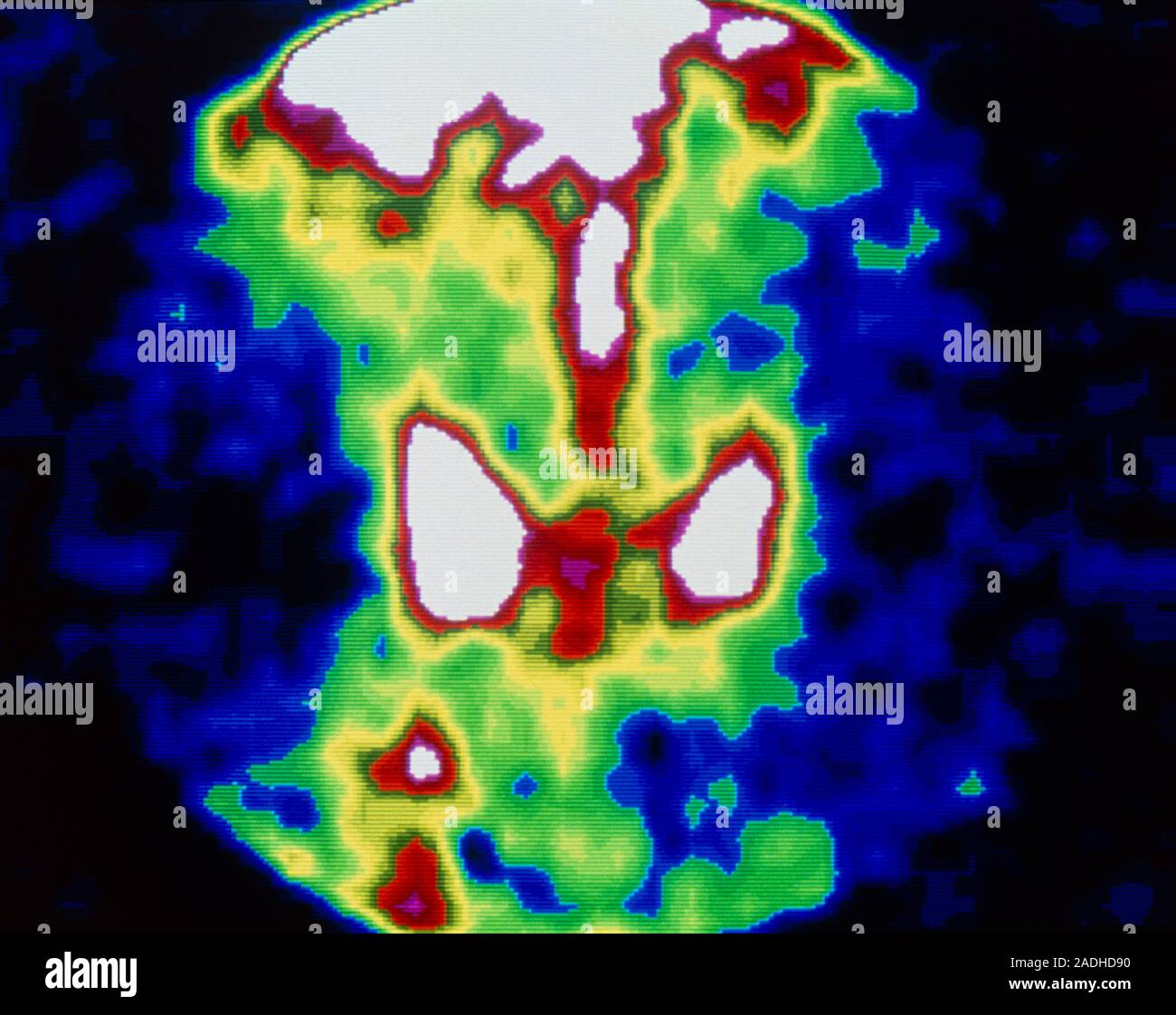 Secondary bone cancer. Coloured gamma scan of metastatic cancer tumours ...