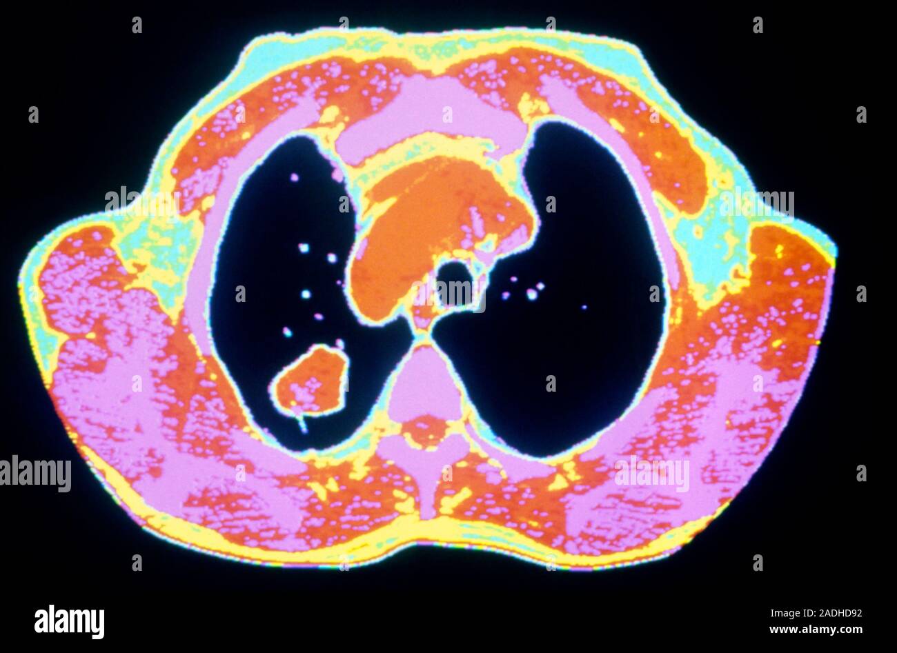 Lung cancer. Coloured computed tomography scan of a patient's chest showing a malignant tumour ...