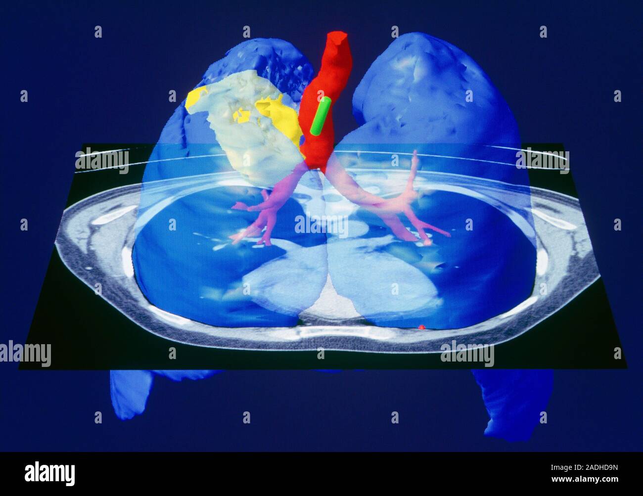 Lung cancer. Coloured three-dimensional Computed Tomography scan (CT scan) of a patient with a ...