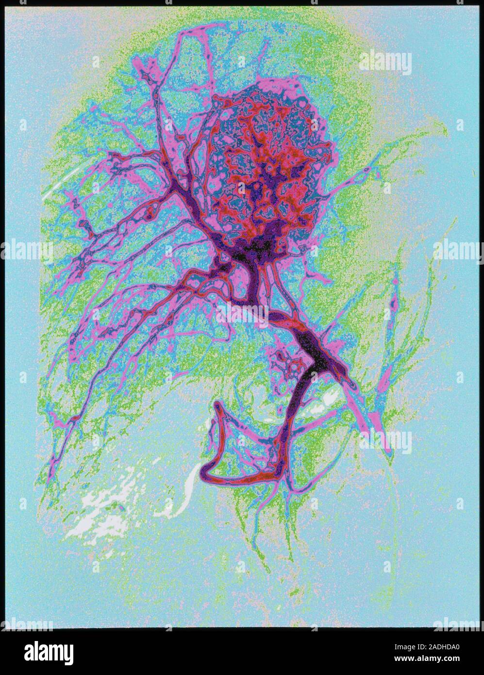 Liver tumour. Coloured angiogram X-ray of the liver showing a rounded ...