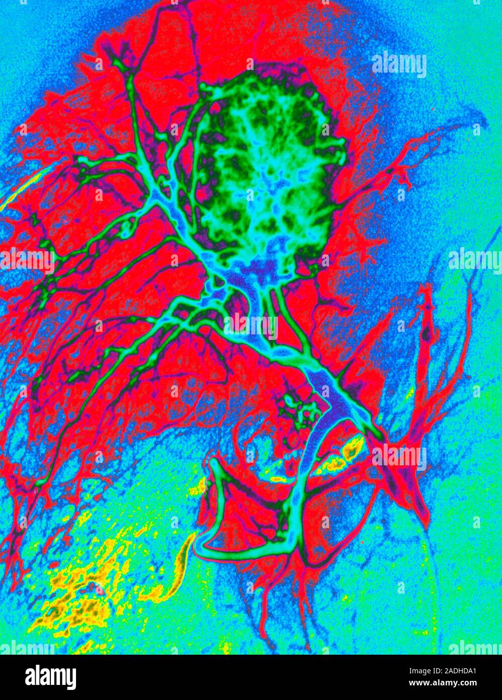 Liver tumour. Coloured angiogram X-ray of the liver showing a rounded ...
