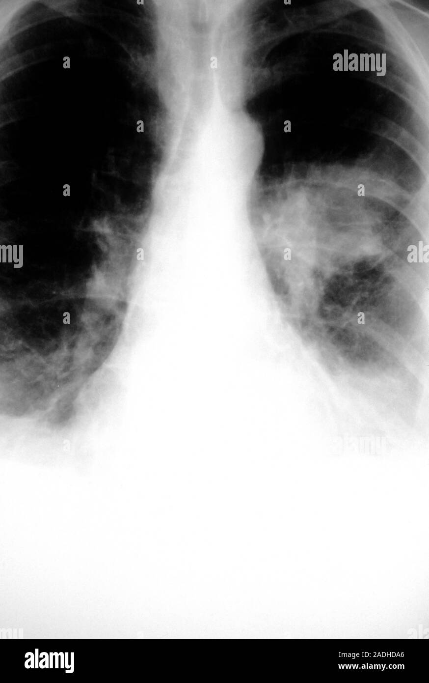 Chest Xray Of Lung Cancer In A Man Stock Photo More