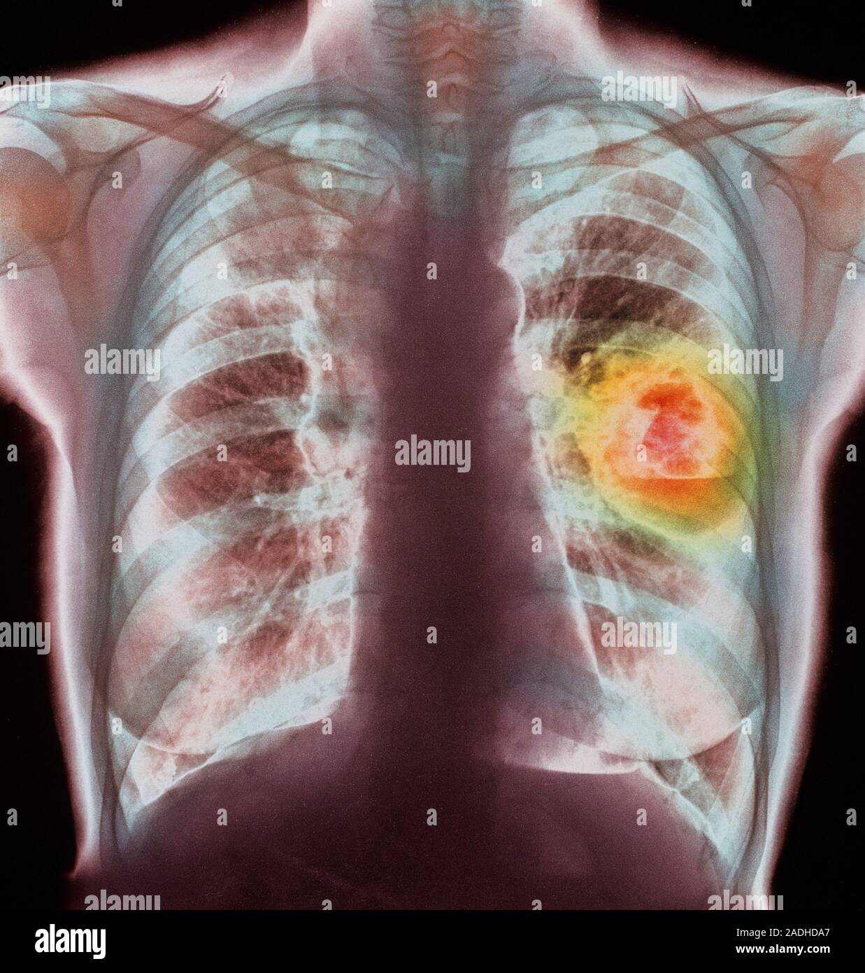Lung cancer. Coloured chest X-ray showing lung cancer in frontal view ... Lung cancer. Coloured chest X-ray showing lung cancer in frontal view ...