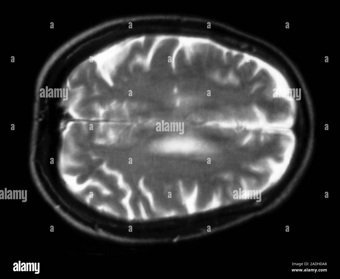 Brain tumour. Magnetic resonance imaging (MRI) scan of an axial section ...
