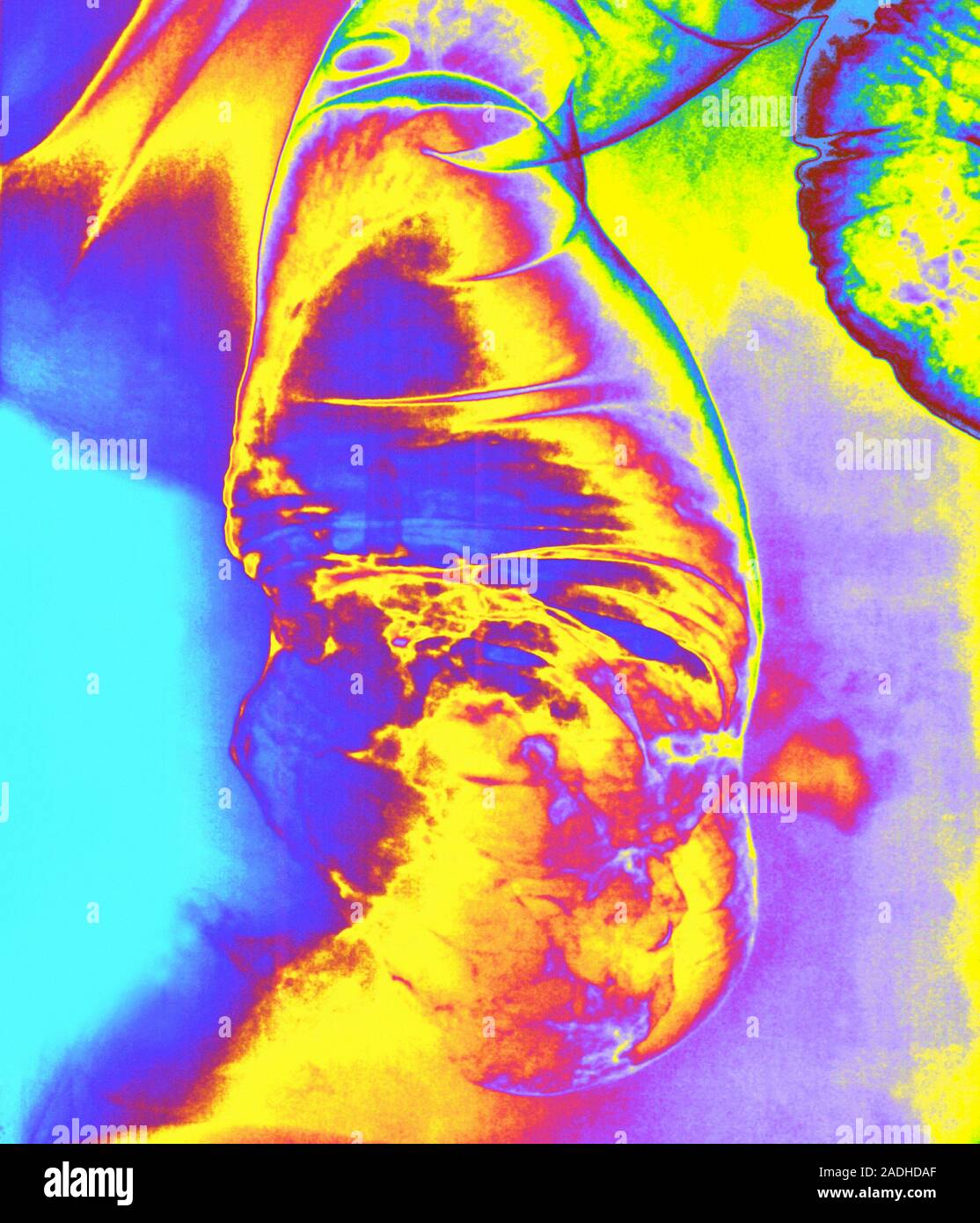 Colon cancer. Coloured barium X-ray showing cancer of the human colon ...