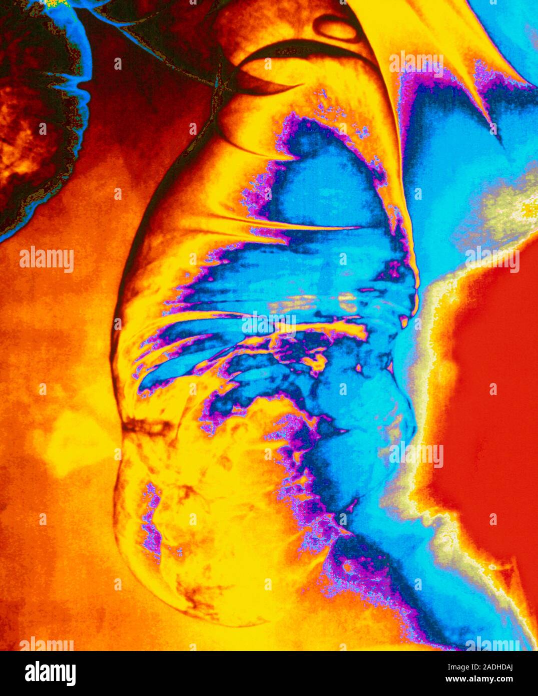 Colon cancer. Coloured barium X-ray showing cancer of the human colon ...