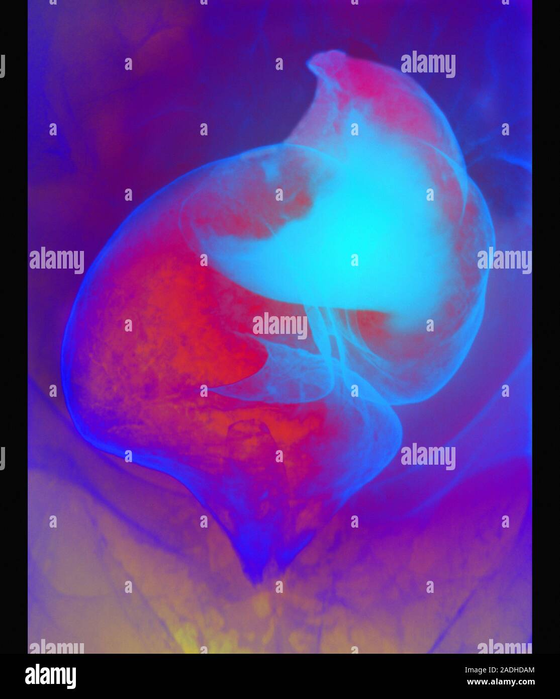Colon cancer. Coloured barium X-ray showing cancer of the human colon ...