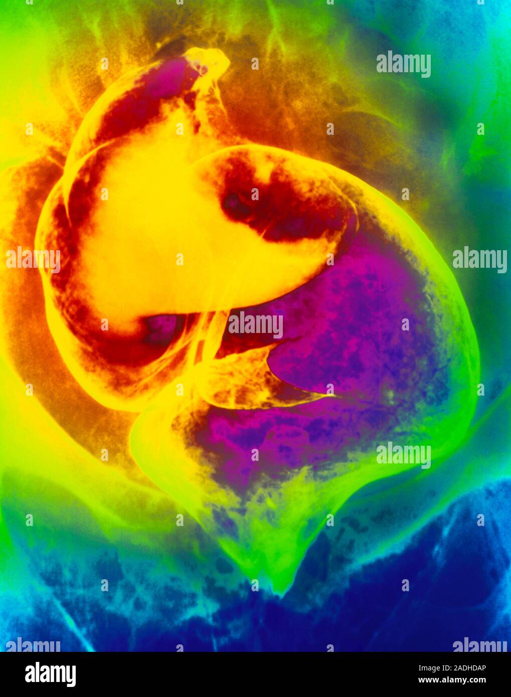 Colon cancer. Coloured barium X-ray showing cancer of the human colon ...