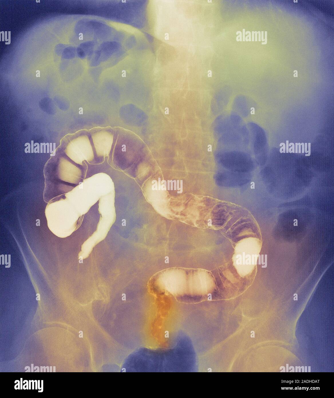 Rectal cancer. Coloured X-ray of the human abdomen in front view ...