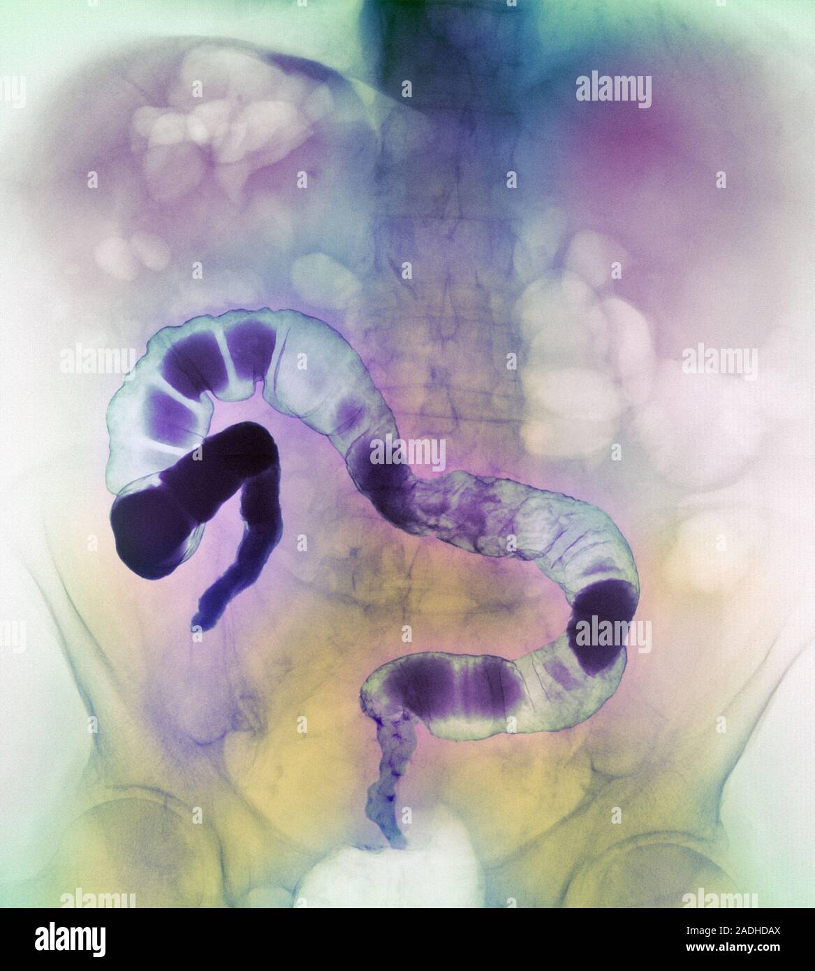 Rectal cancer. Coloured X-ray of the human abdomen in front view ...