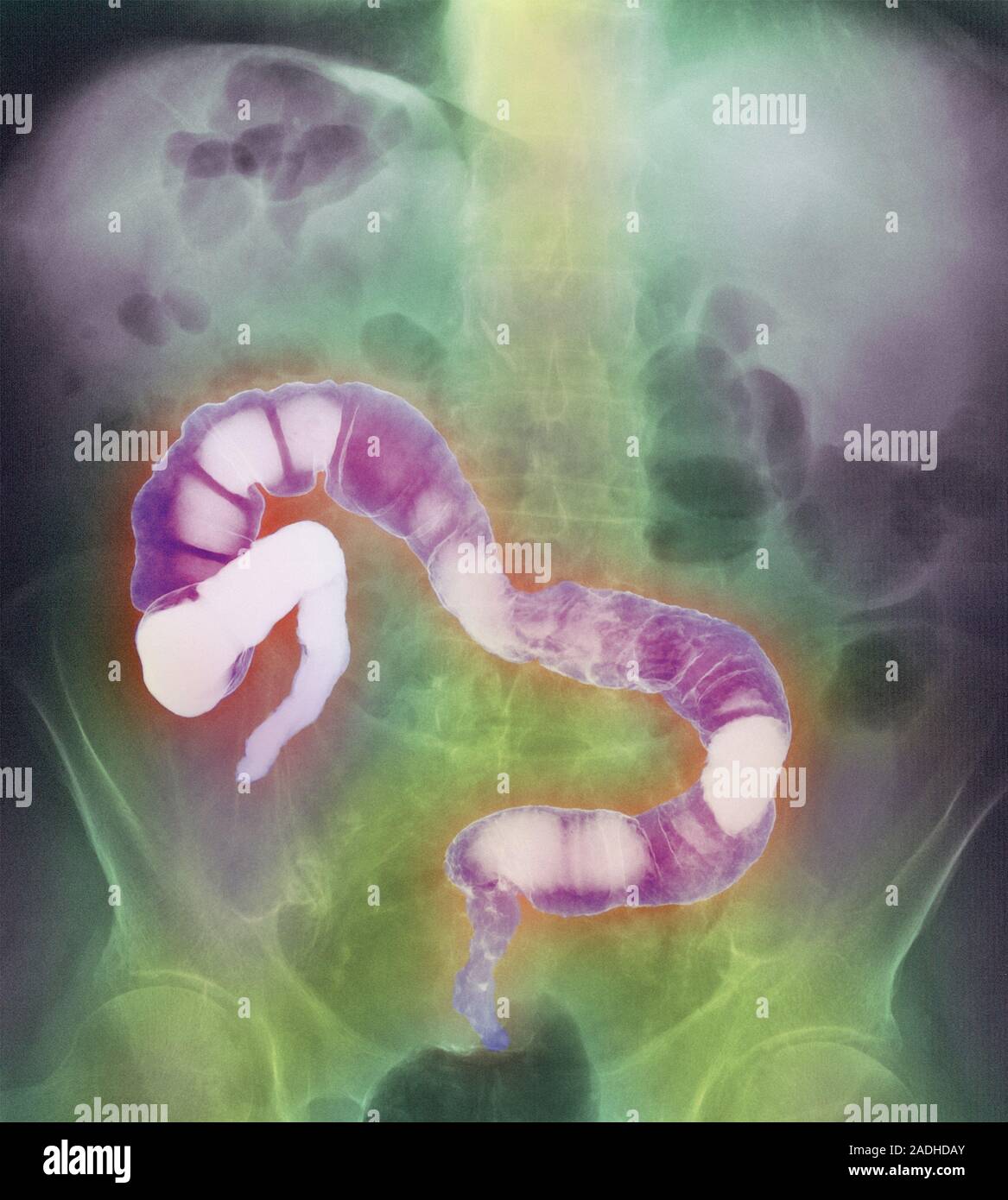 Rectal cancer. Coloured X-ray of the human abdomen in front view ...