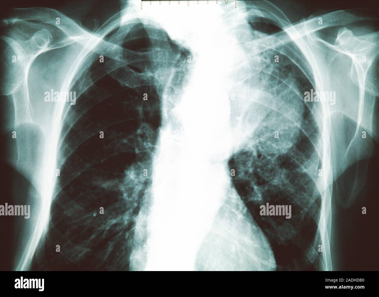 Lung cancer. Chest X-ray of a 70 year old woman showing a cancer ...