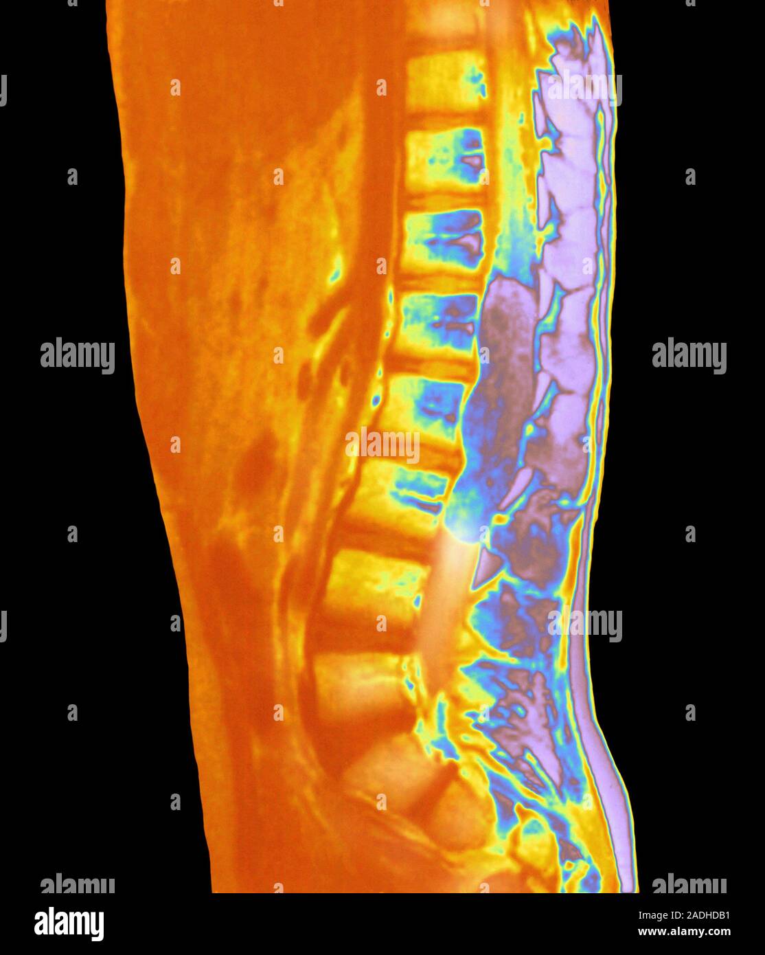 Spinal cord cancer. Coloured magnetic resonance imaging (MRI) scan ...