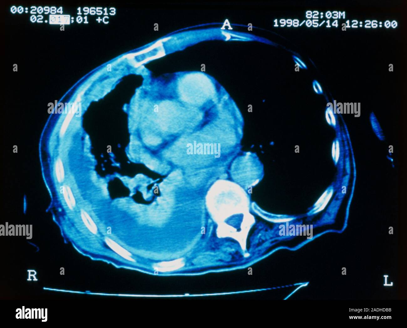 Mesothelioma. Coloured computed tomography (CT) scan of an axial ... Mesothelioma. Coloured computed tomography (CT) scan of an axial ...