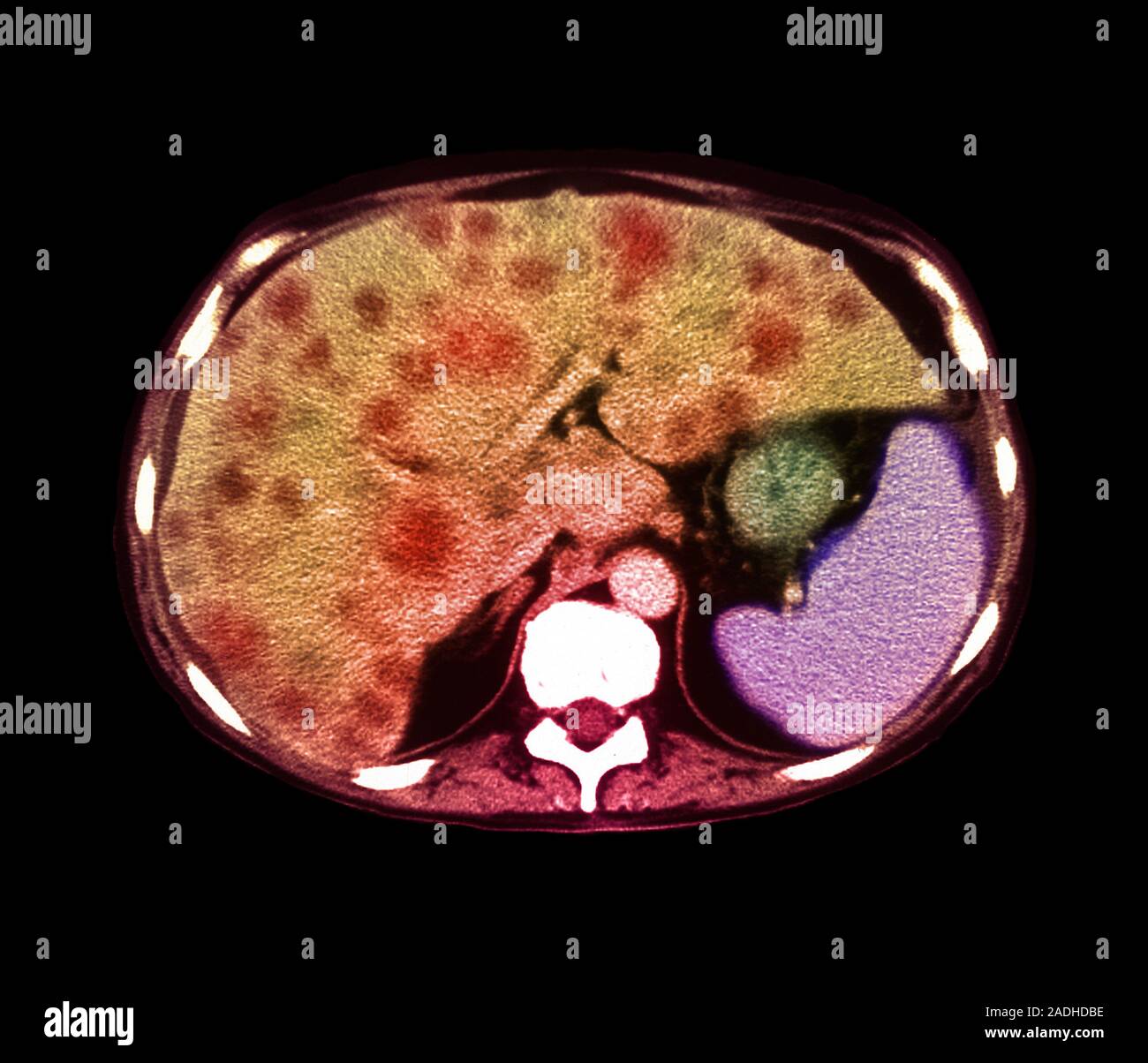 Liver cancer. Coloured computed tomography (CT) scan of an axial ... Liver cancer. Coloured computed tomography (CT) scan of an axial ...