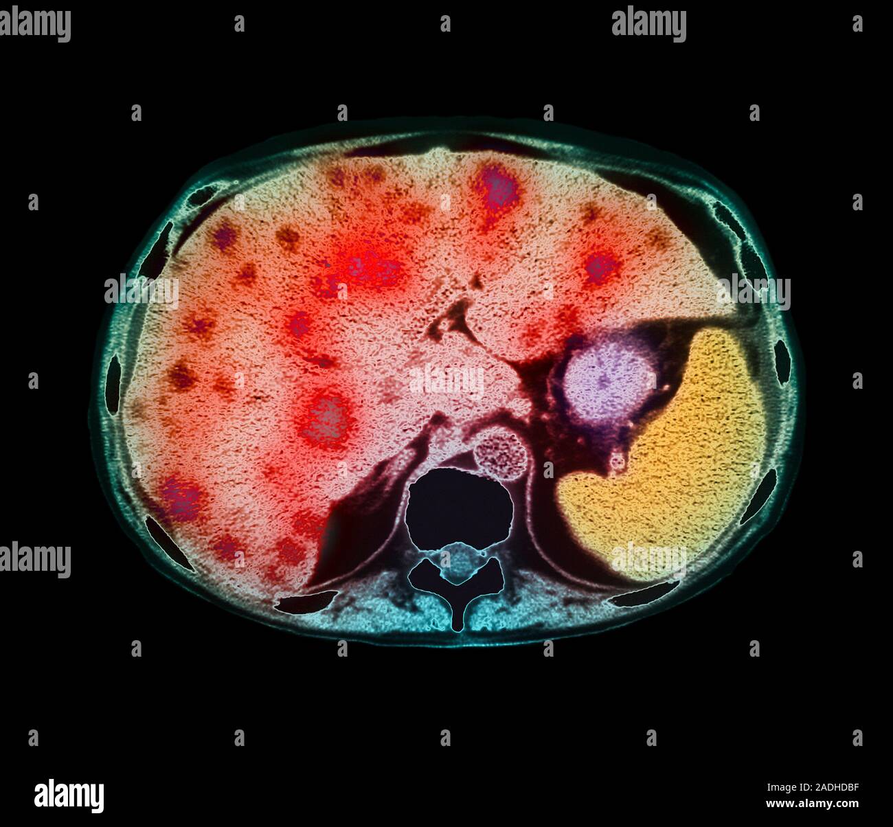Liver cancer. Coloured computed tomography (CT) scan of an axial section through the human ...