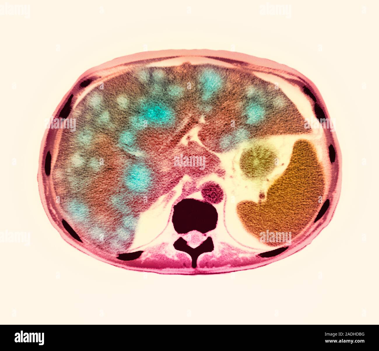 Liver cancer. Coloured computed tomography (CT) scan of an axial section through the human ...