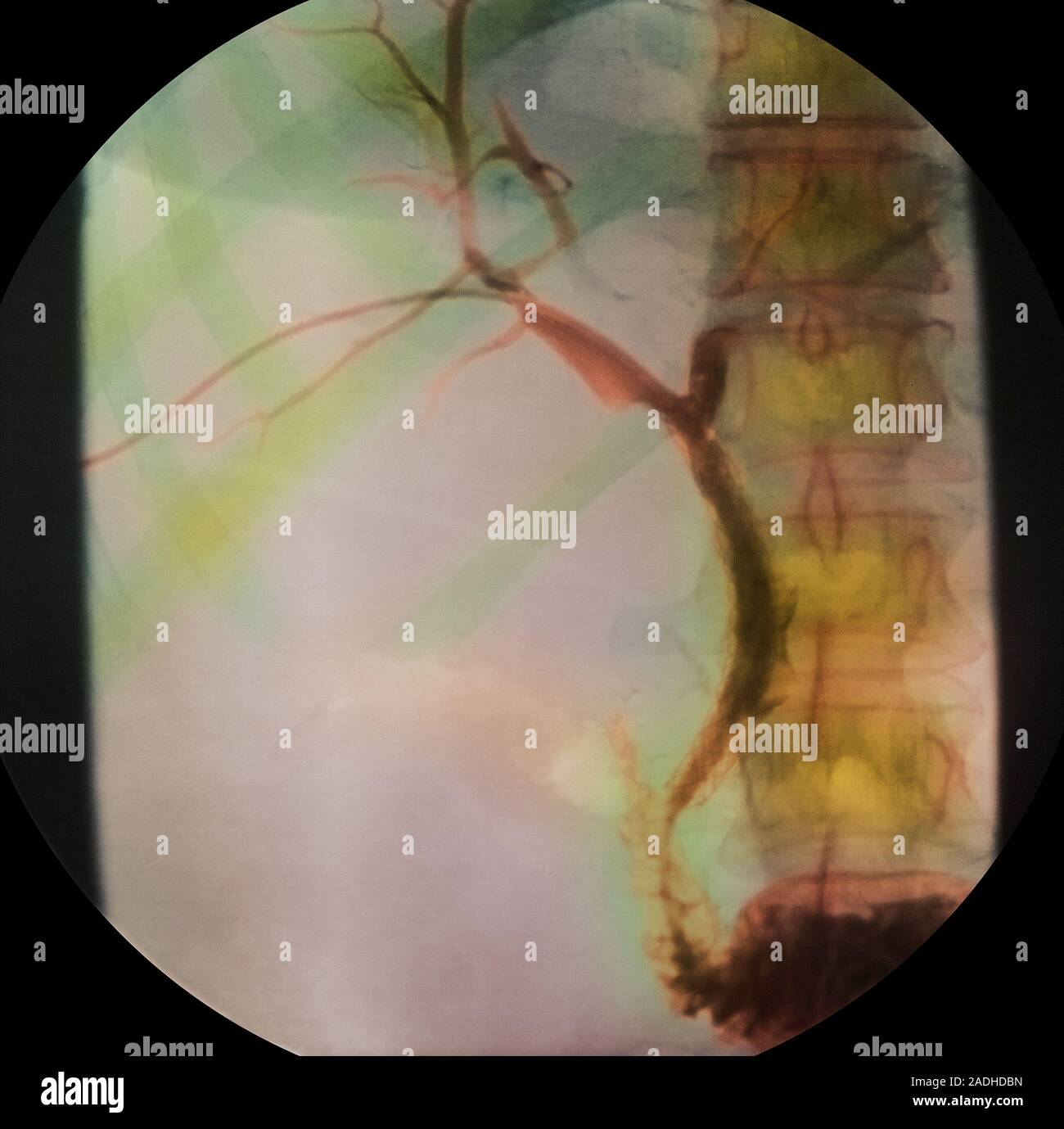 Bile duct cancer. Coloured cholangiogram (X-ray) of part of a common ...