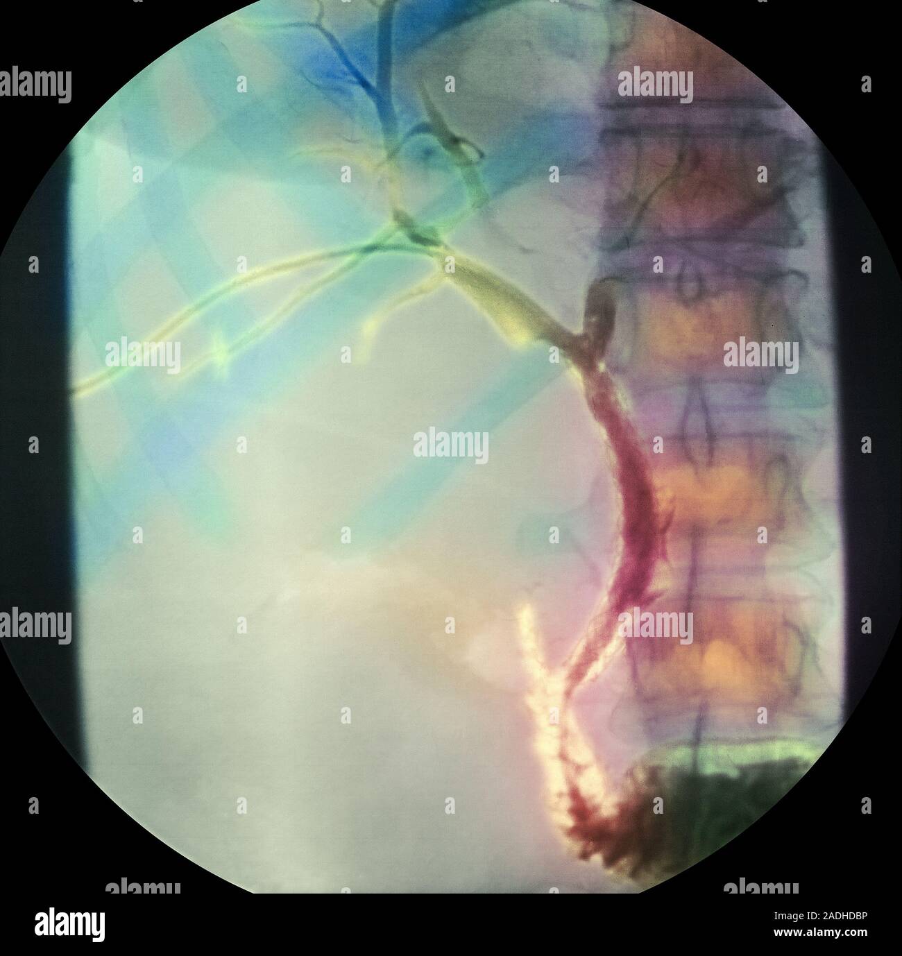 Bile Duct Cancer Coloured Cholangiogram X Ray Of Part Of A Common