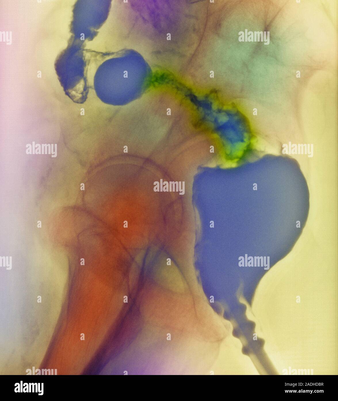 Colon cancer. Coloured barium X-ray showing cancer (blue/yellow, upper ...