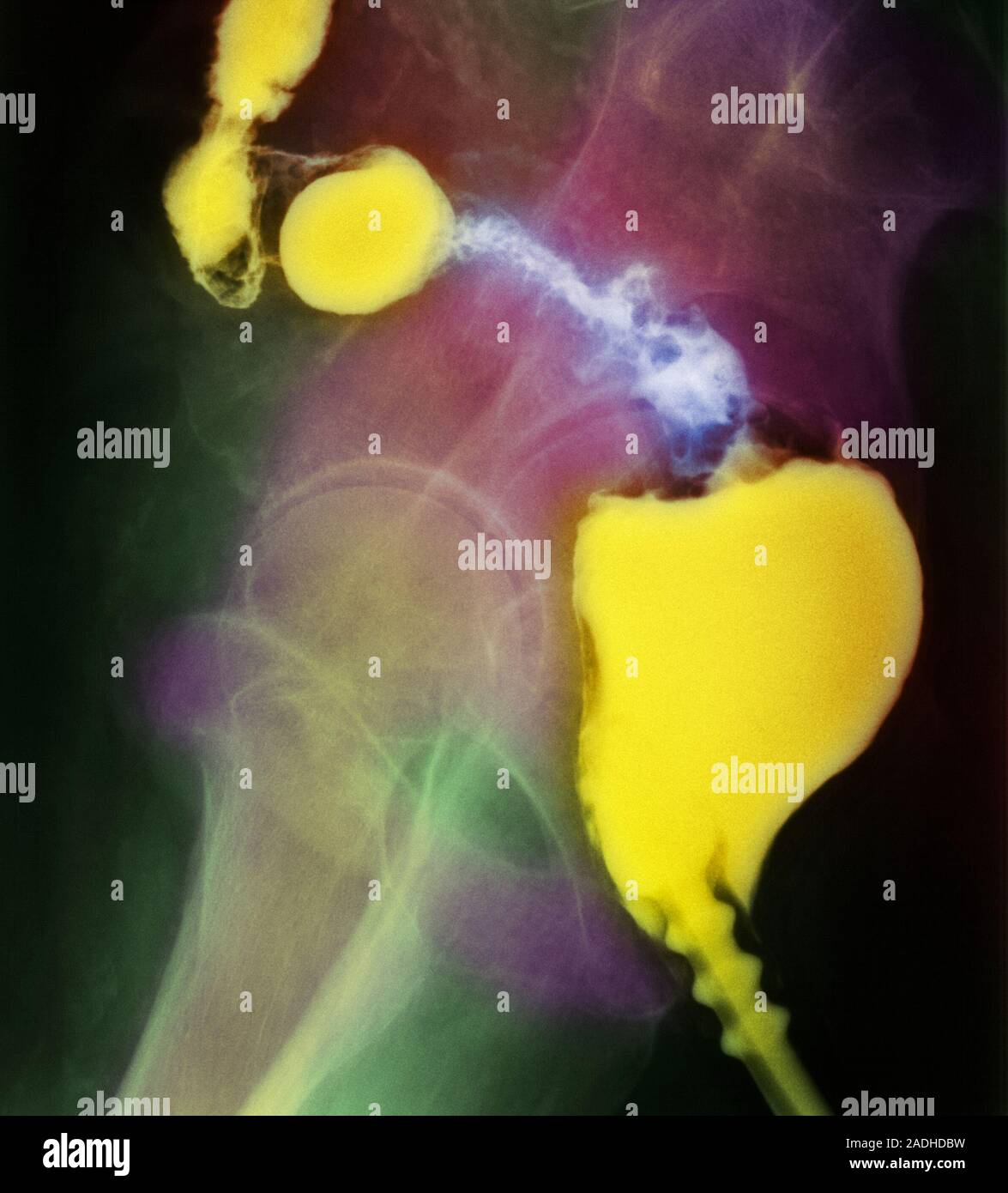 Colon cancer. Coloured barium X-ray showing cancer (blue, upper right ...