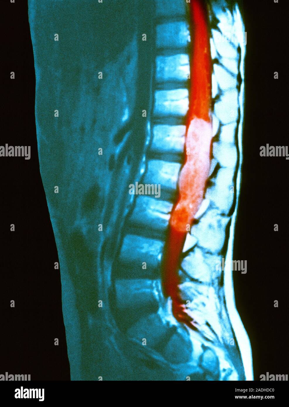 Spinal cord cancer. Coloured magnetic resonance imaging (MRI) scan ...