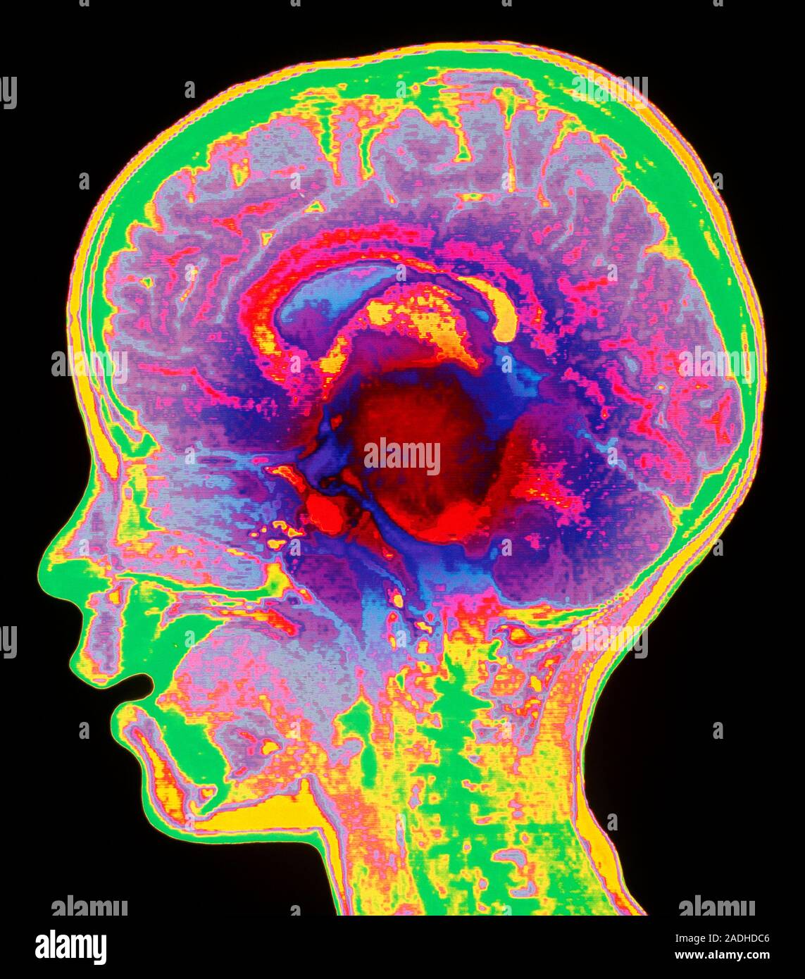 Brain cancer. Coloured magnetic resonance imaging (MRI) scan of a sagittal (vertical) section ...