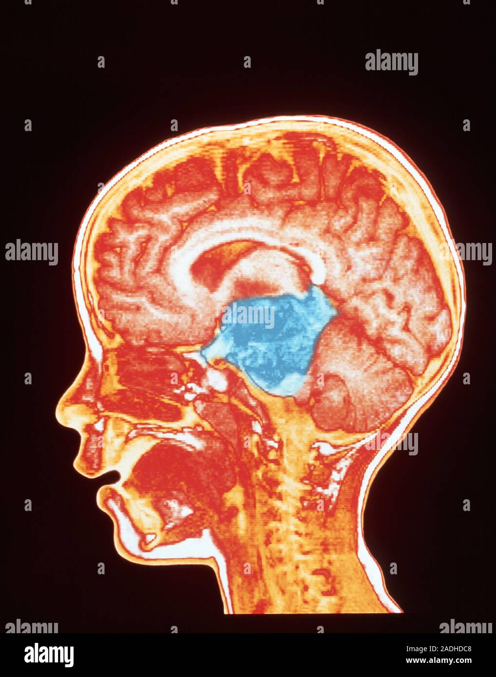 Brain cancer. Coloured magnetic resonance imaging (MRI) scan of a sagittal (vertical) section ...