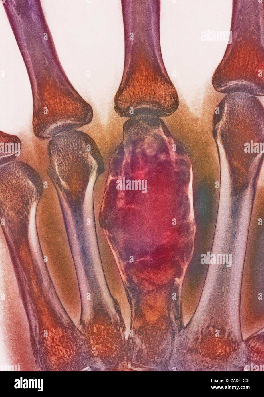 Bone tumour. Coloured X-ray of a hand showing a tumour growing in a ...