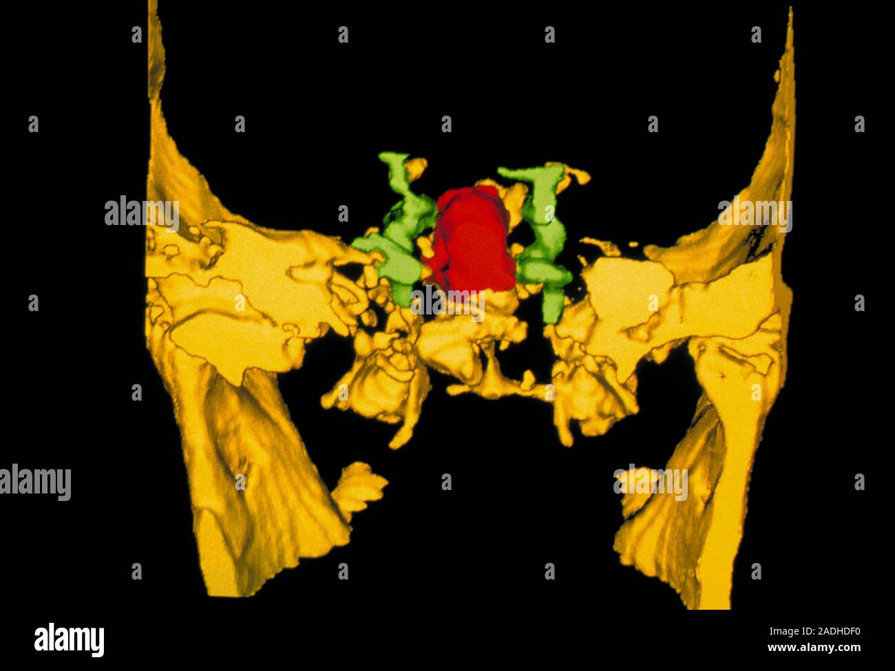 Pituitary gland tumour. Coloured three-dimensional computed tomography ... Pituitary gland tumour. Coloured three-dimensional computed tomography ...