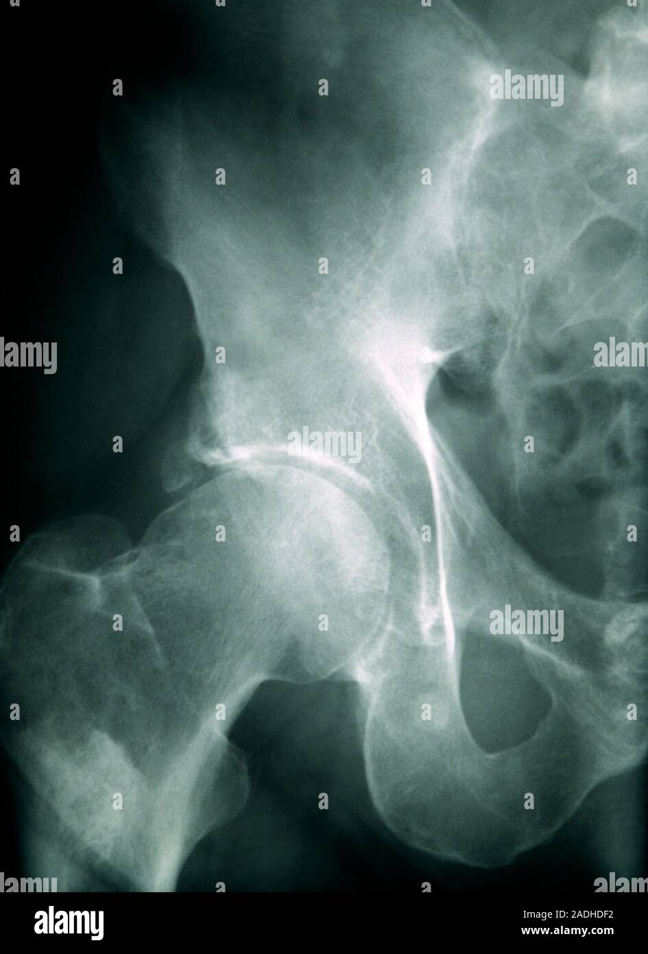 Secondary bone cancer. X-ray of part of the pelvis of a 68-year-old man ...