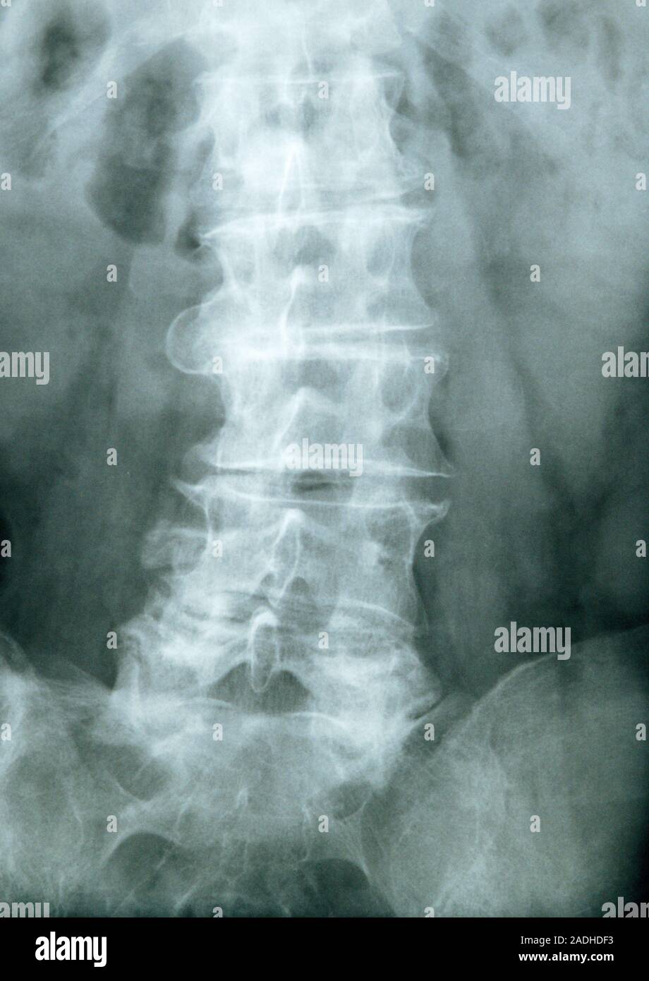 Secondary bone cancer. X-ray of the spine of a 68- year-old man with ...