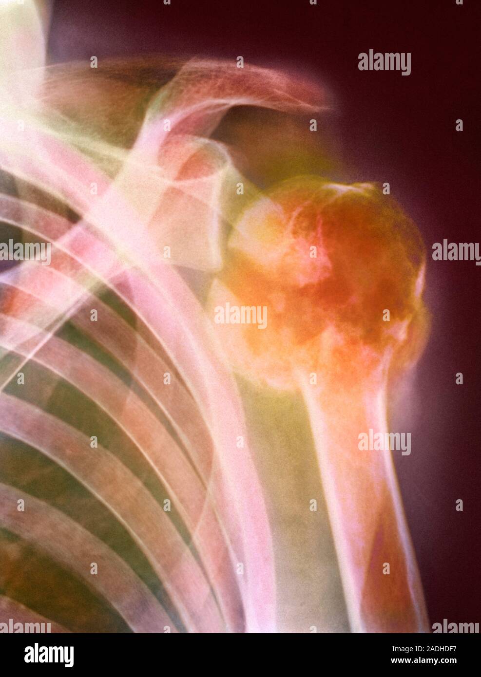 Bone marrow cancer. Coloured X-ray of the head of the humerus (upper ...