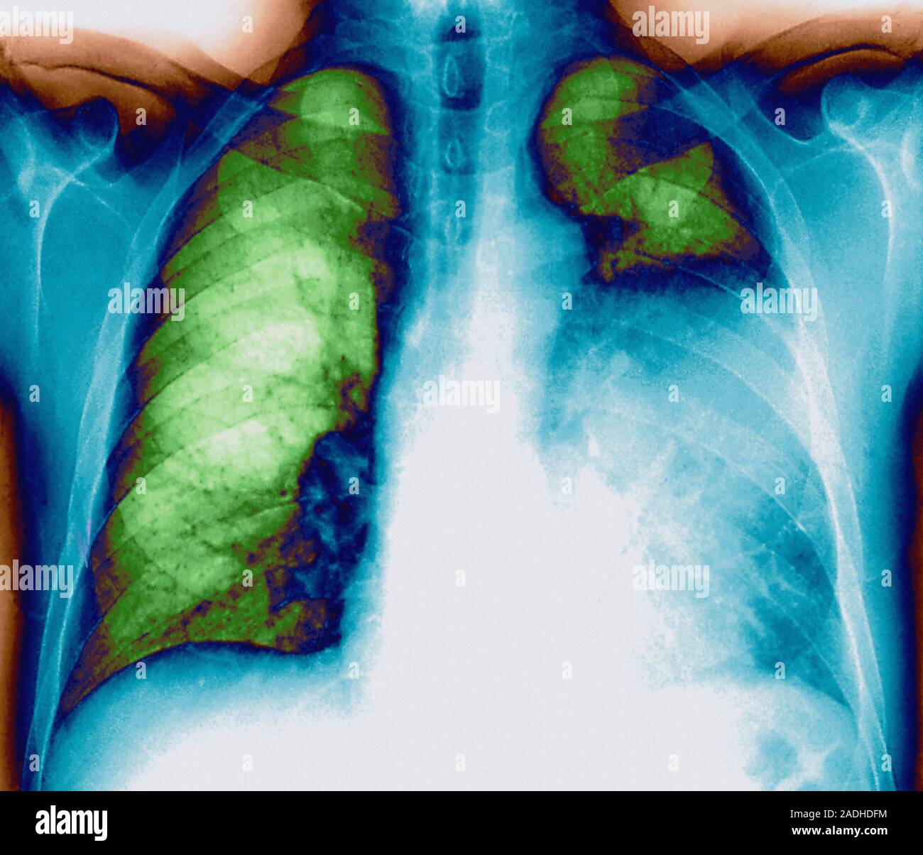 Lung cancer. Coloured X-ray of the chest of a 62- year-old patient with ...