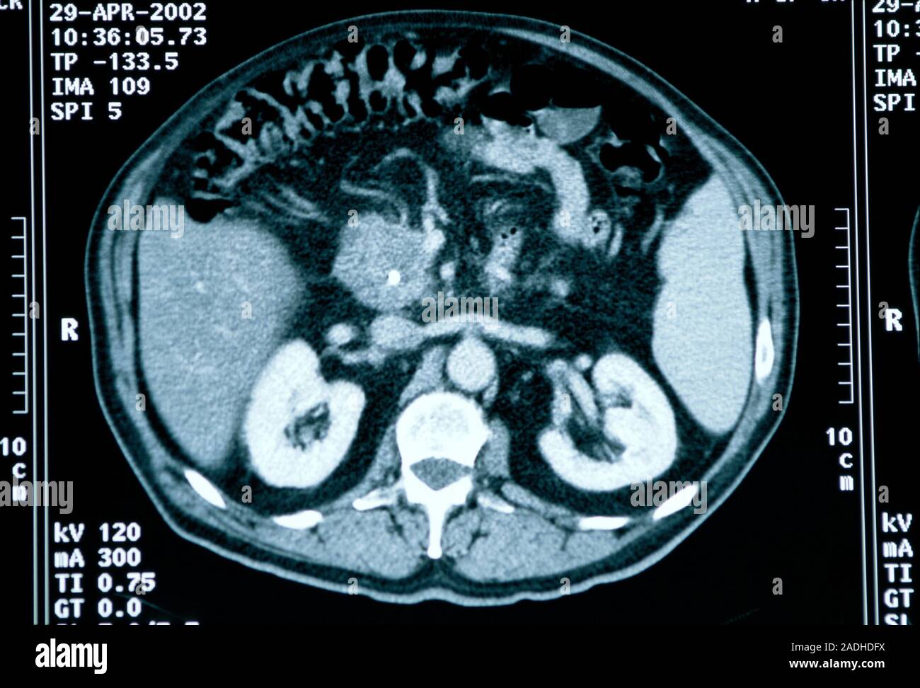 Pancreas cancer. Axial computed tomography (CT) scan through a 63-year ...