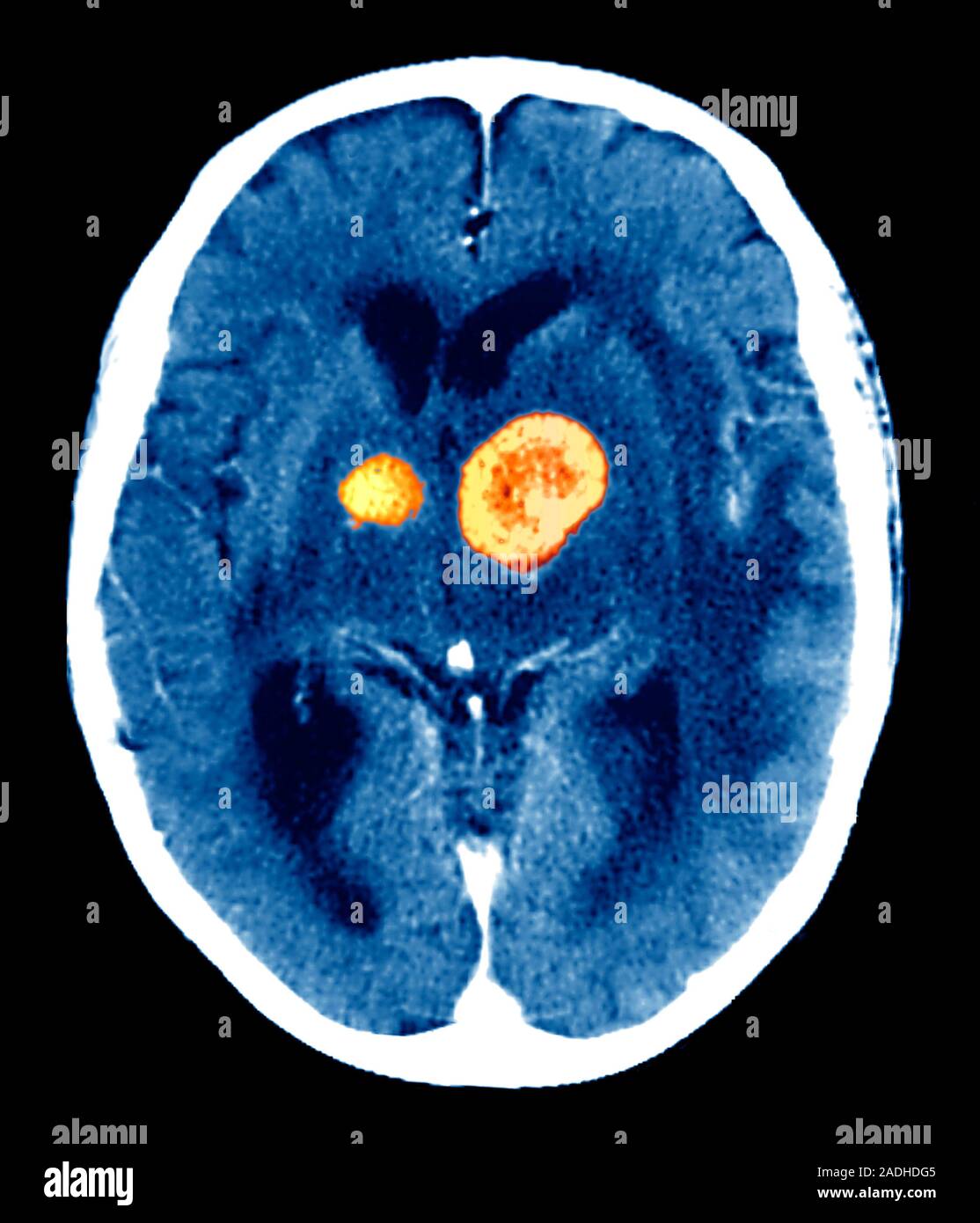 Brain cancer. Coloured axial (horizontal) computed tomography (CT) scan ...