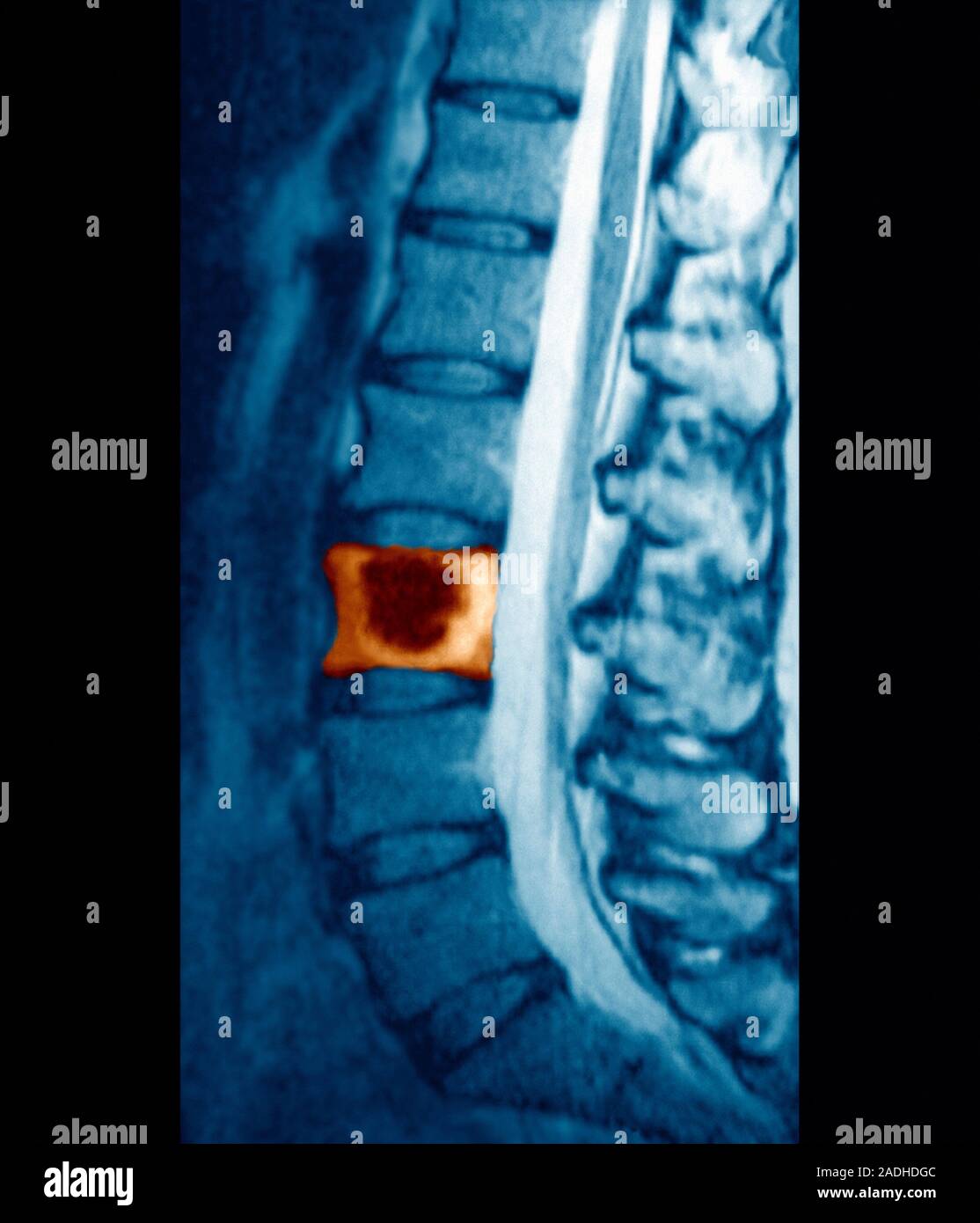 Bone cancer. Coloured sagittal (side) magnetic resonance imaging (MRI ...