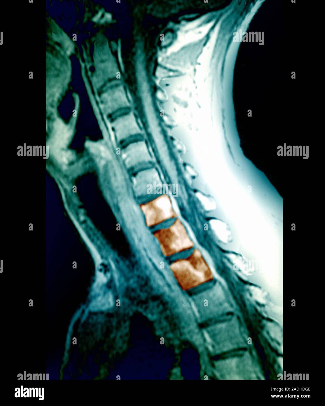 Bone cancer. Coloured sagittal (side) magnetic resonance imaging (MRI ...