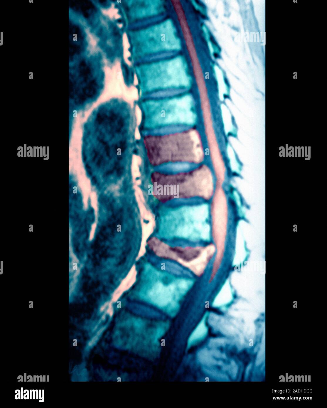 Bone cancer. Coloured sagittal (side) magnetic resonance imaging (MRI ...