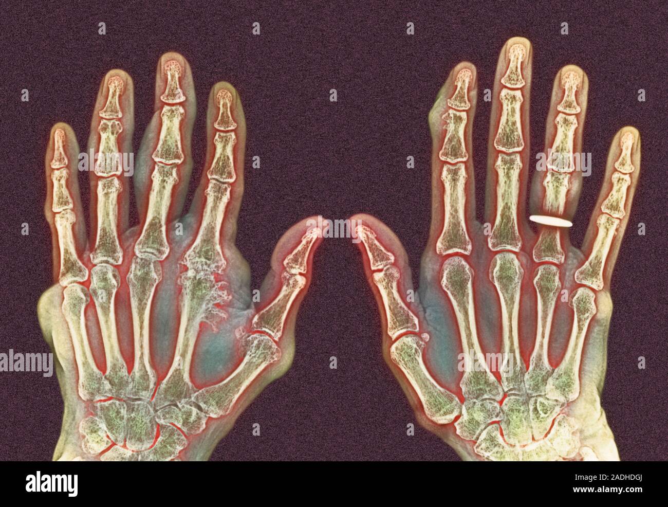 Bone cancer, coloured X-ray. Patient's hands affected by chondrosarcoma ...