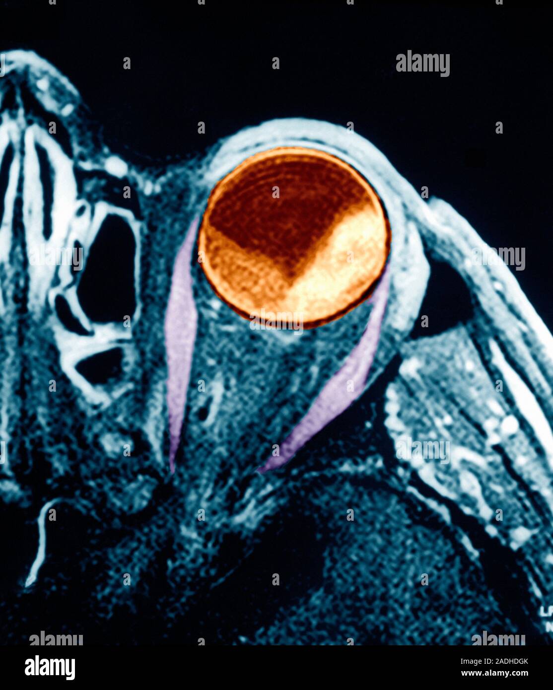 Eye cancer. Coloured axial magnetic resonance imaging (MRI) scan of a ...
