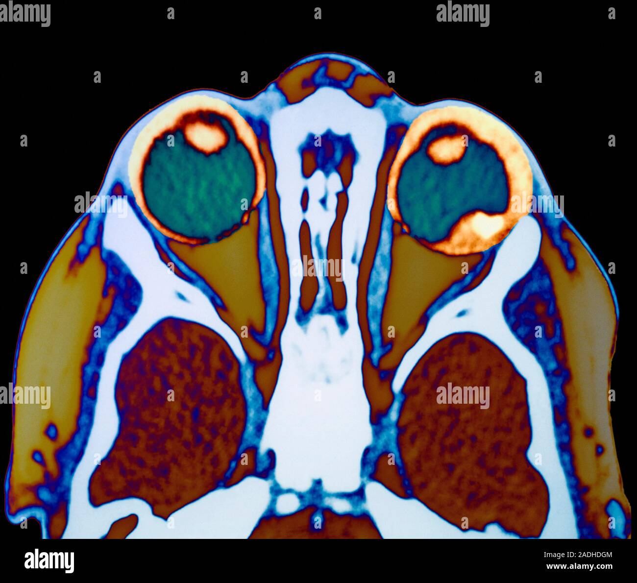 Eye cancer. Coloured axial magnetic resonance imaging (MRI) scan of a ...
